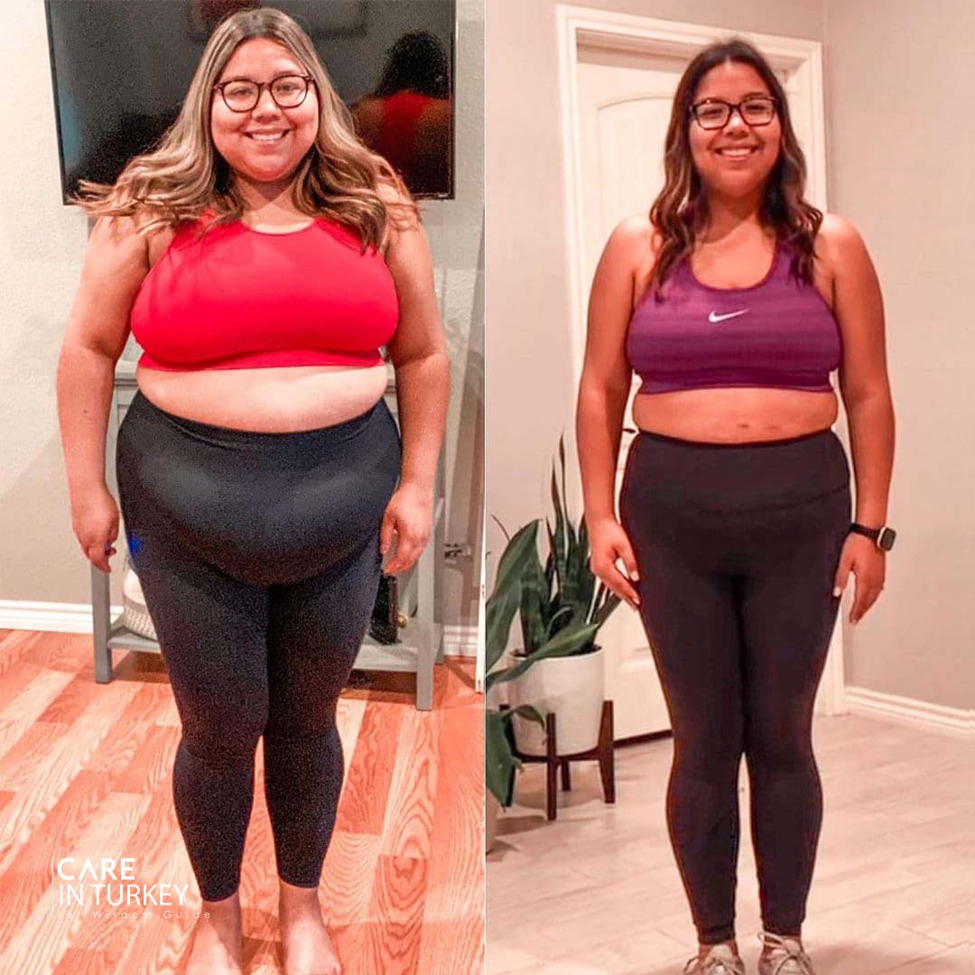 Before And After Photos Bariatric Surgery Med Turkish