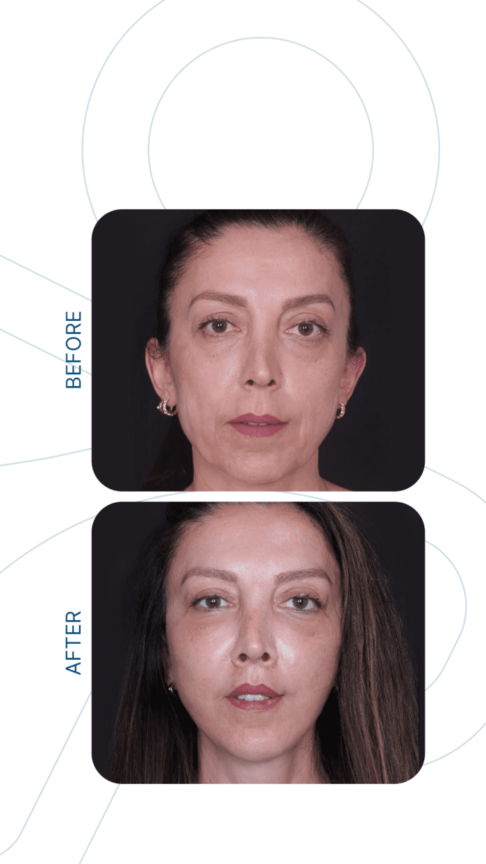 Before & After Photos | Plastic Surgery | Med Turkish